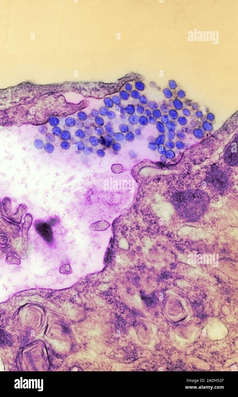Hantavirus infection. Coloured transmission electron micrograph (TEM ...