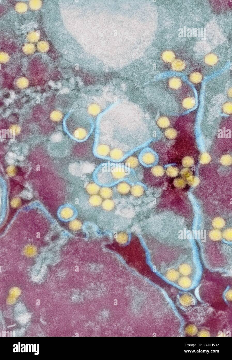 Dengue fever virus particles. Coloured transmission electron micrograph ...