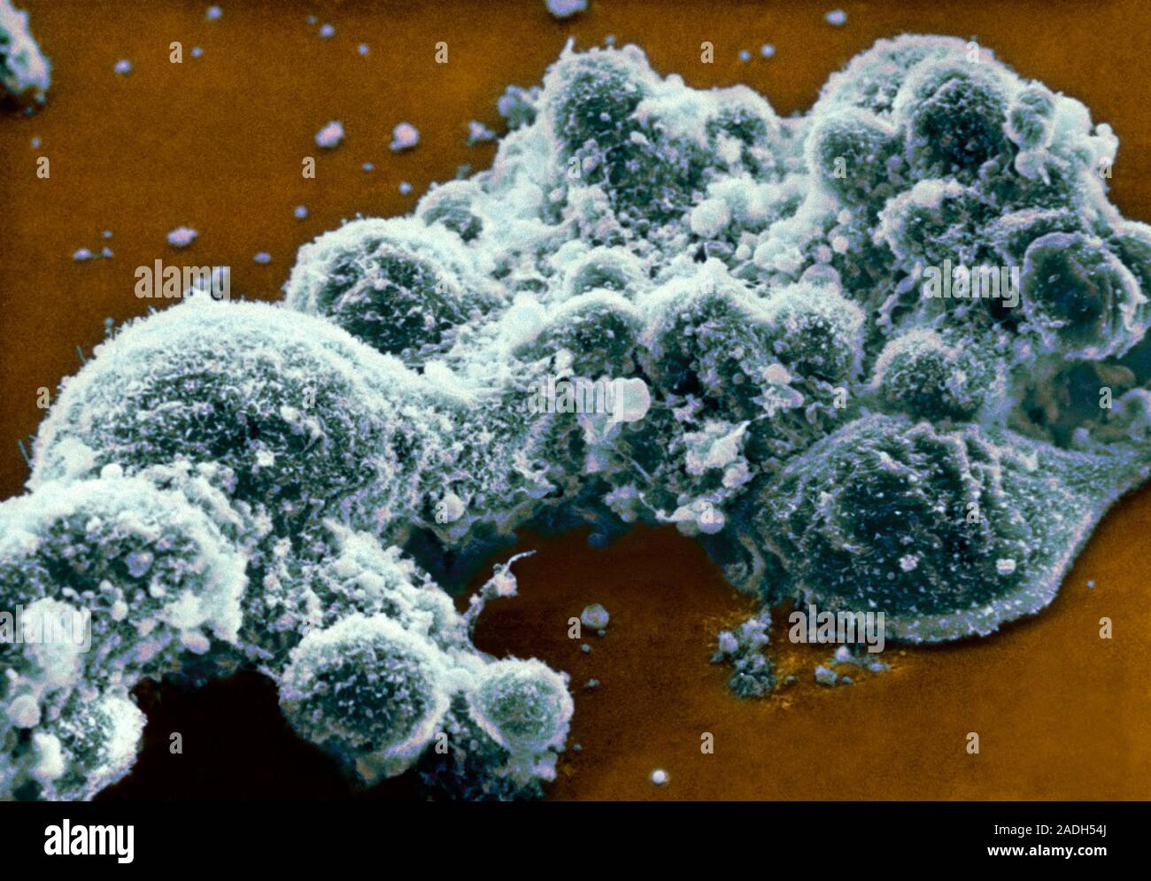 Herpes simplex virus infection. Coloured scanning electron micrograph ...