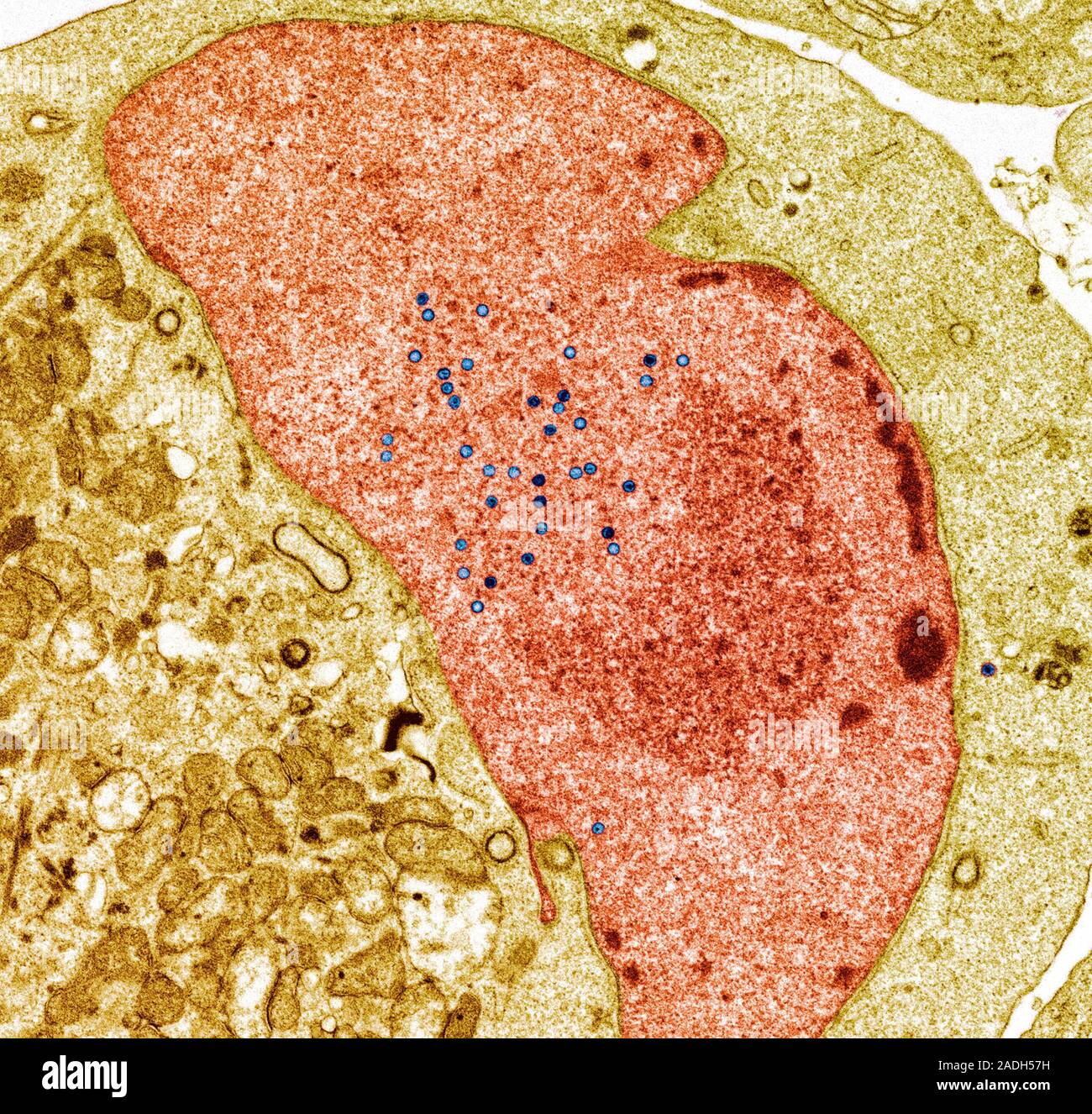 Epstein-Barr virus infection. Coloured transmission electron micrograph (TEM) of a section ...