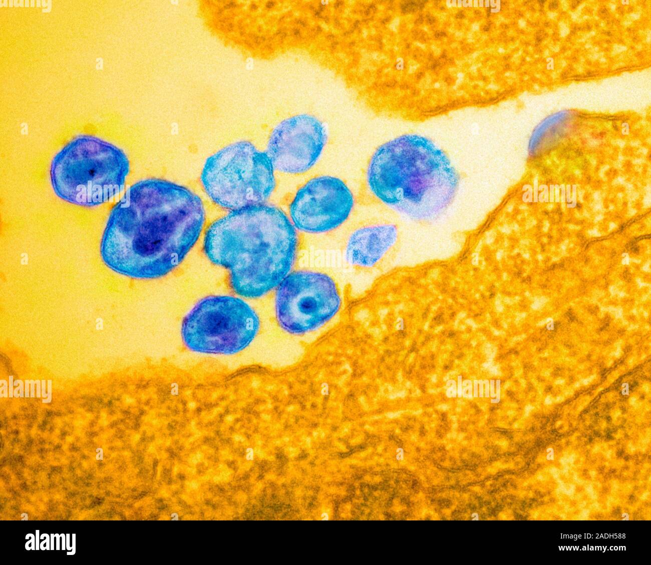HIV particles, coloured transmission electron micrograph (TEM). HIV ...