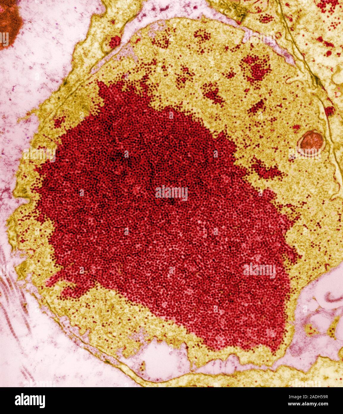 Papillomavirus particles. Coloured transmission electron micrograph ...