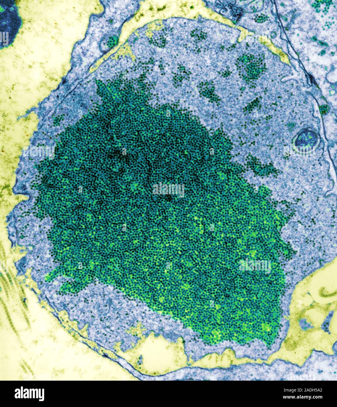 Papillomavirus particles. Coloured transmission electron micrograph ...
