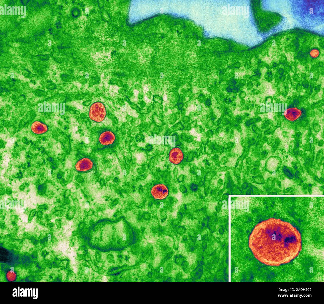 HIV particles. Coloured transmission electron micrograph (TEM) of human ...