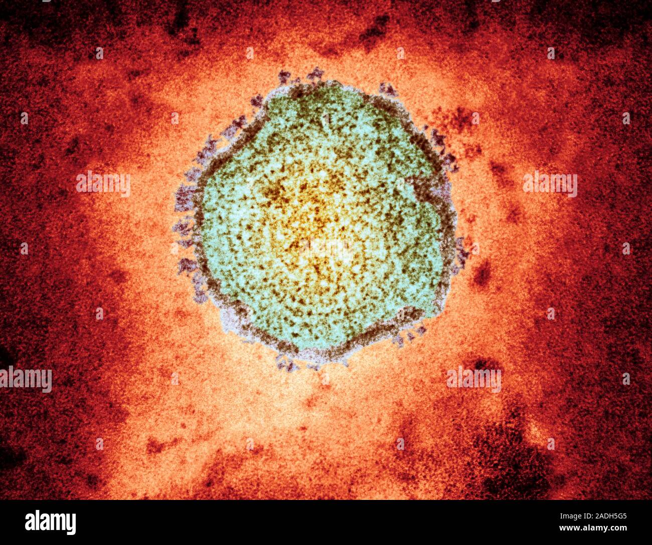 Mumps virus particle, coloured transmission electron micrograph (TEM ...