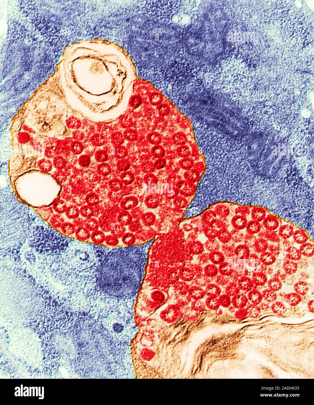 SARS virus particles. Coloured transmission electron micrograph (TEM ...