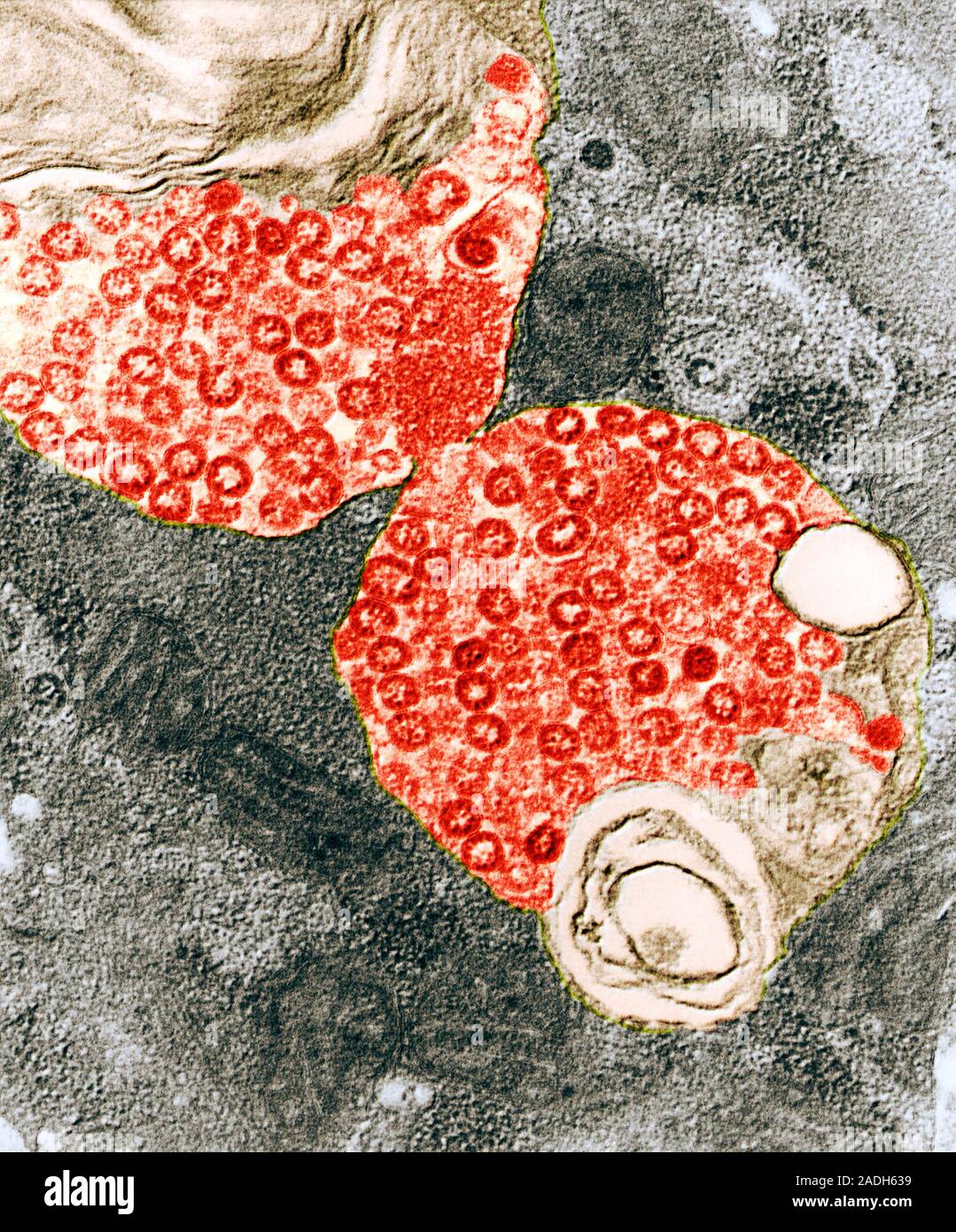 SARS virus particles. Coloured transmission electron micrograph (TEM ...