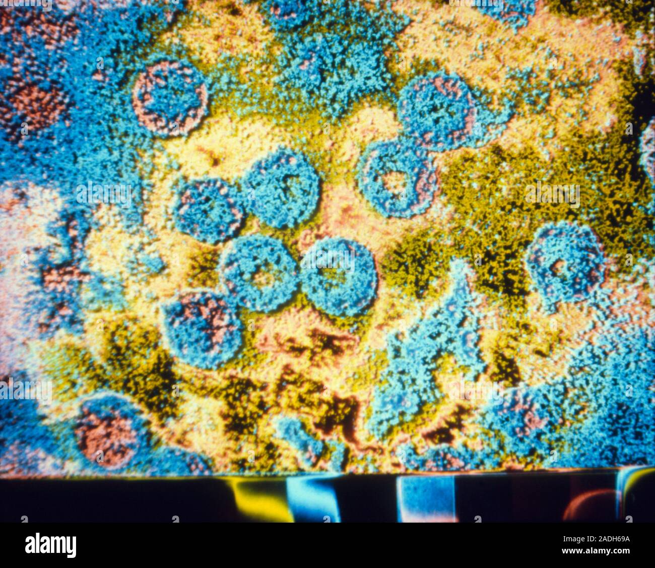 False colour transmission electron micrograph of Hepatitis B viruses ...