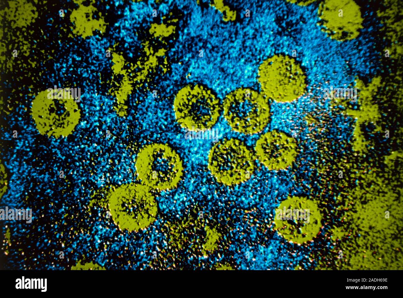 False Colour Transmission Electron Micrograph Tem Of Hepatitis B Virus Cores Hepatitis B
