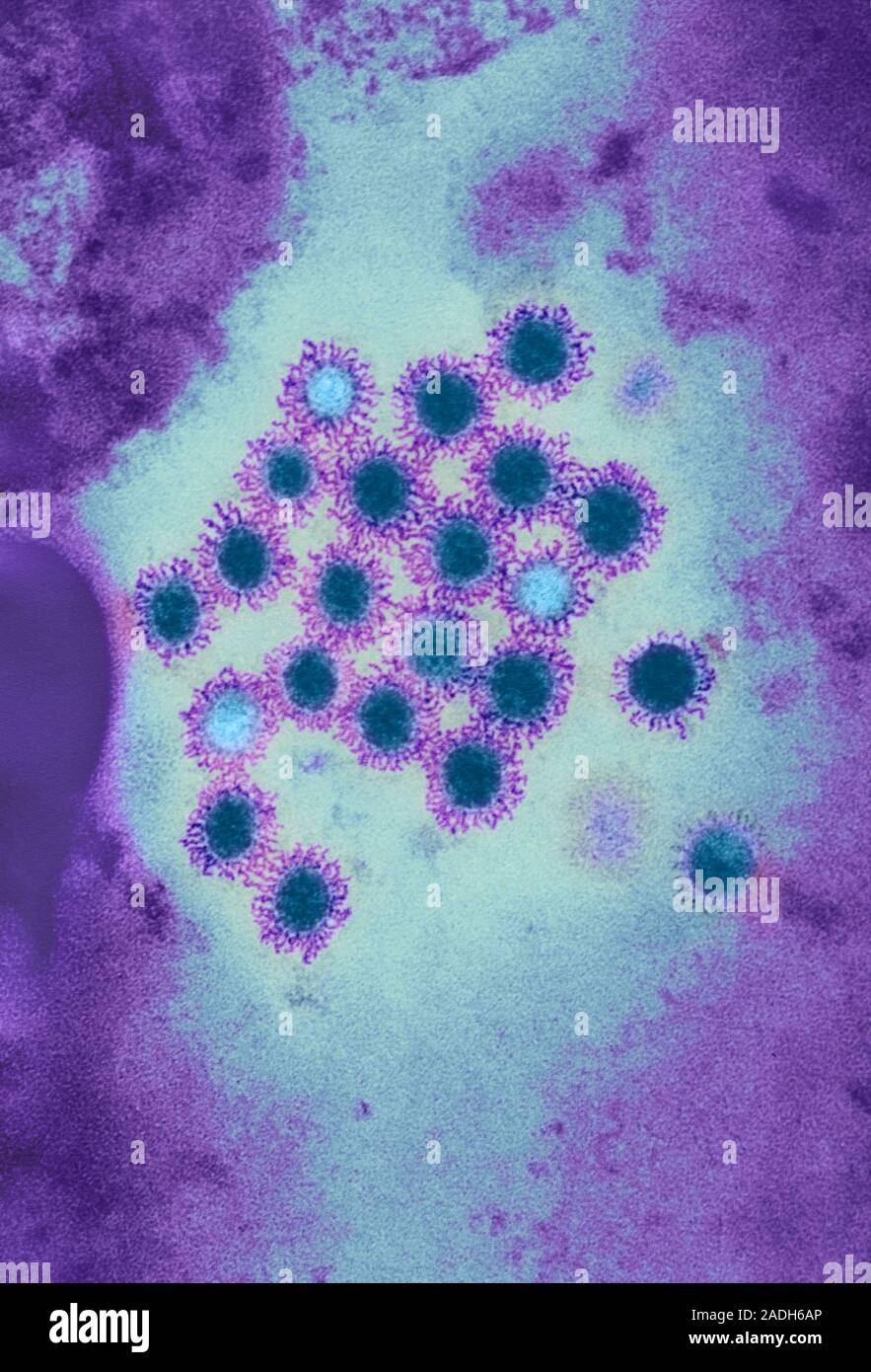 Hepatitis B virus. Coloured transmission electron micrograph (TEM) of ...