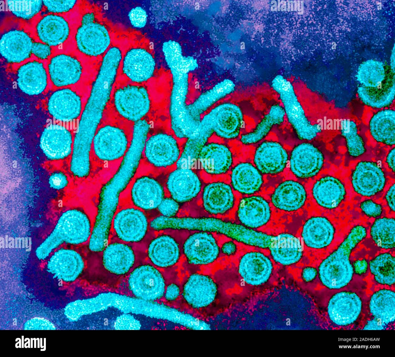Hepatitis B viruses, coloured transmission electron micrograph (TEM ...