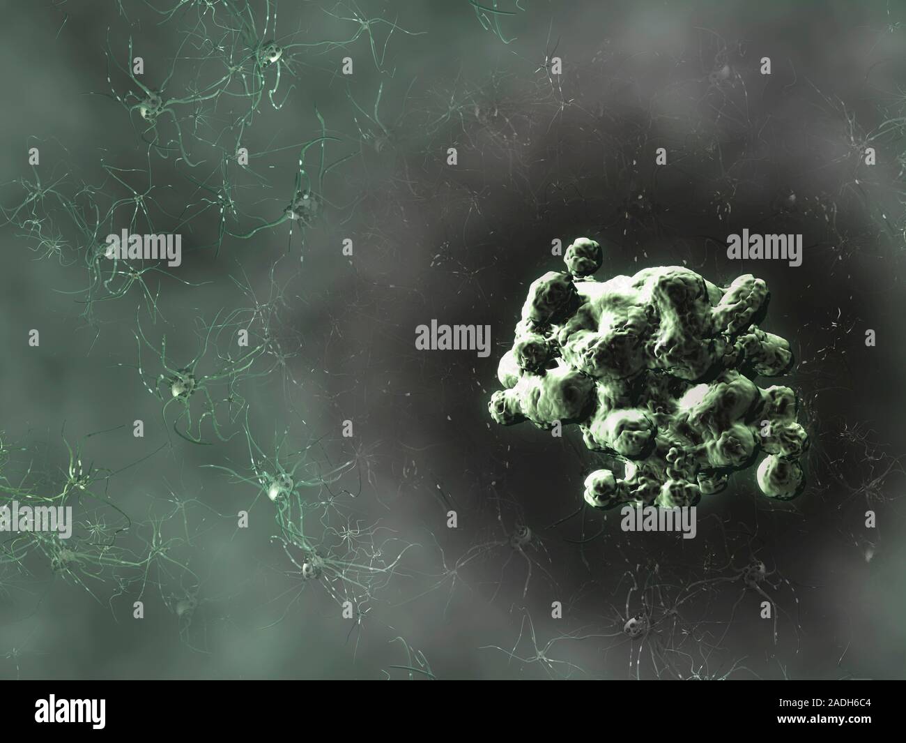 Prion protein plaque (right) surrounded by nerve cells (seen mainly on ...