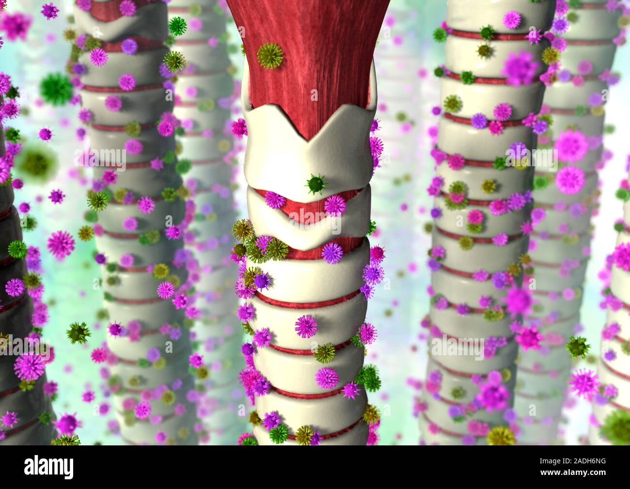 Viral throat infection. Artwork of several tracheae (windpipes) being ...