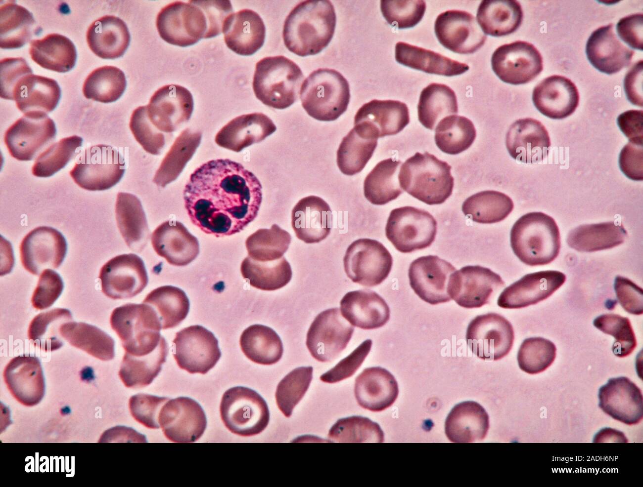 Light micrograph of human blood showing deformed red blood cells in ...