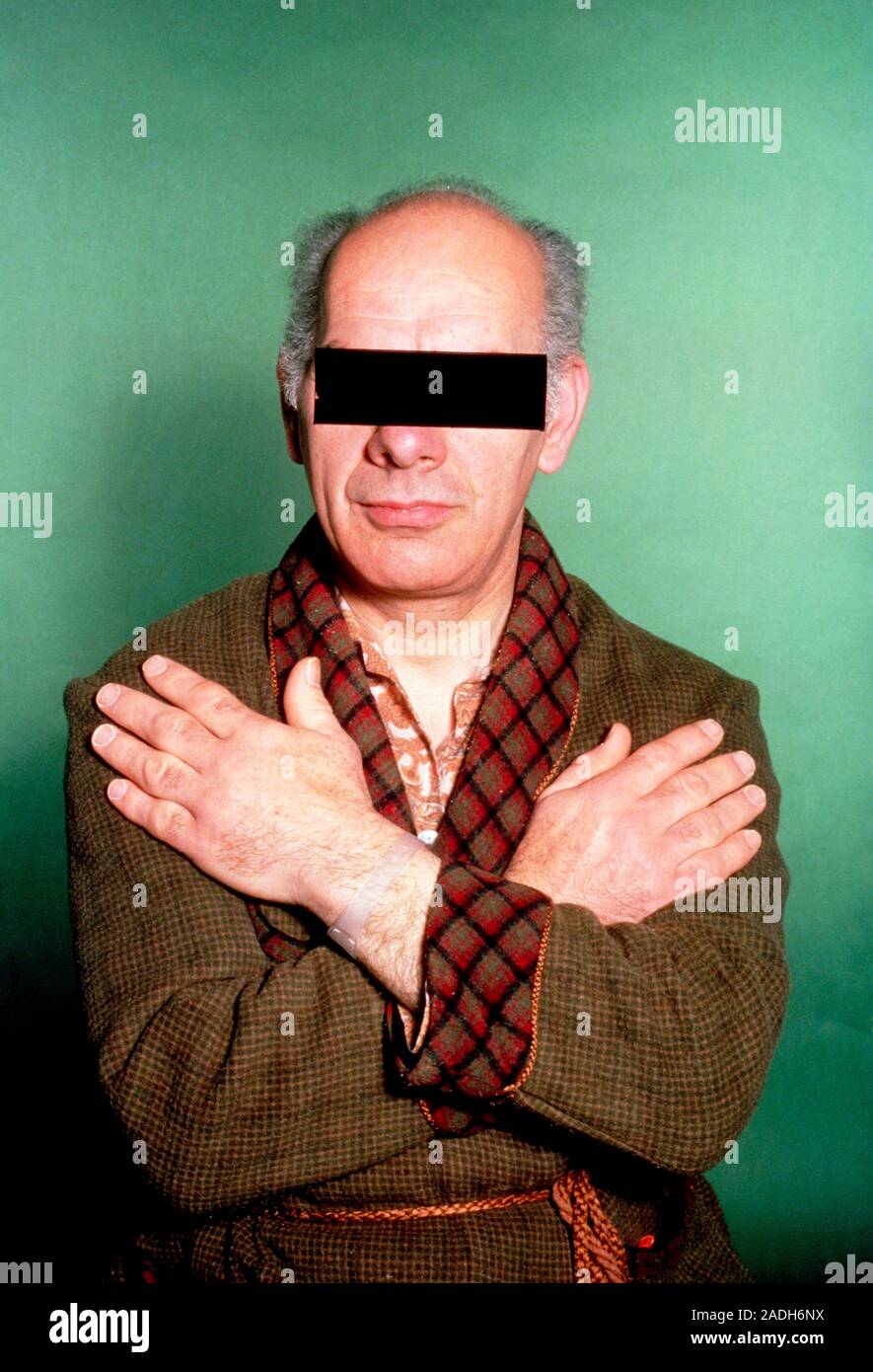 Man suffering from acromegaly, a condition which results in an increase ...