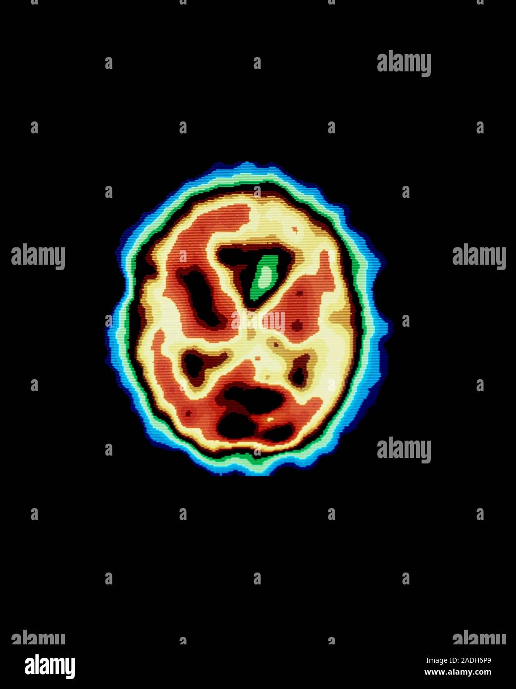 Positron emission tomography (PET) scan of the brain of a person with ...