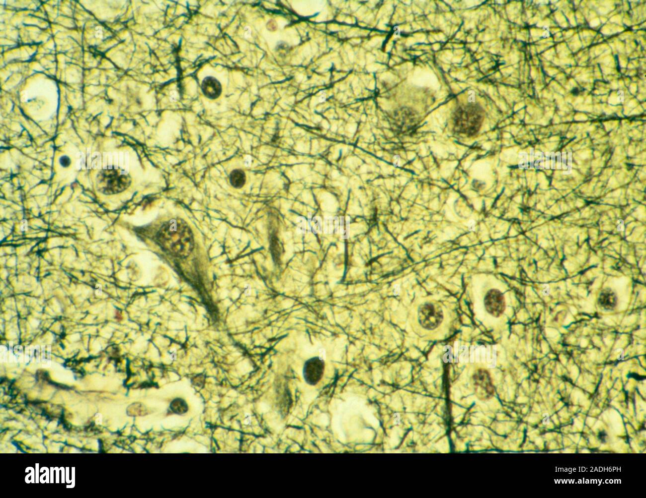 Light micrograph of human brain tissue in Alzheimer's disease, showing ...