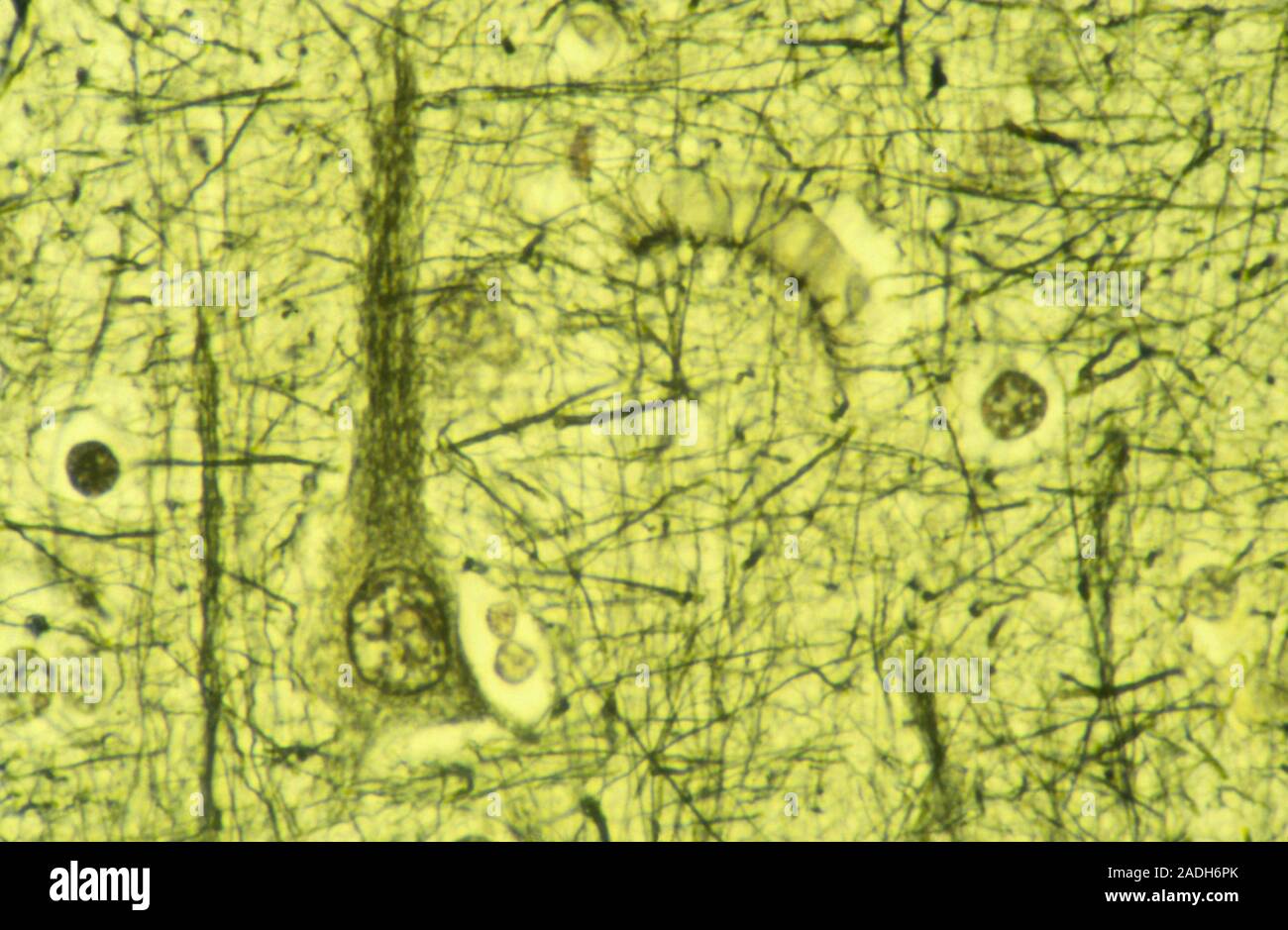 Light micrograph (yellow cast) of a section of the brain of a person ...