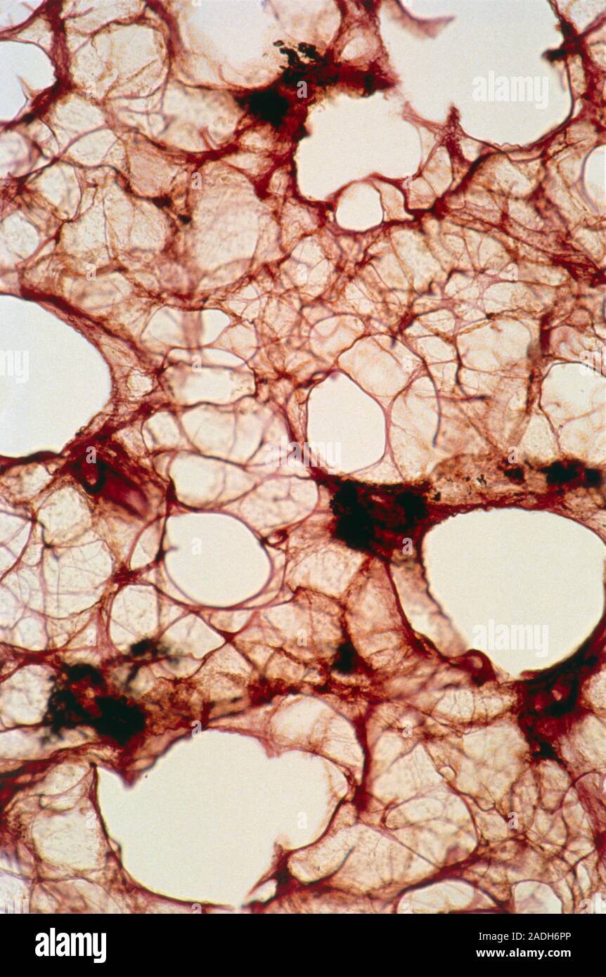 Light micrograph of human lung containing particles of inspired coal ...