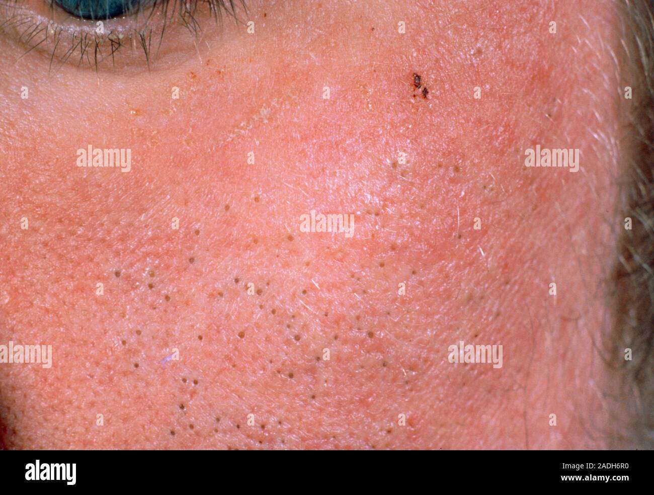 Acne vulgaris affecting a man's face, showing pattern of blackheads ...