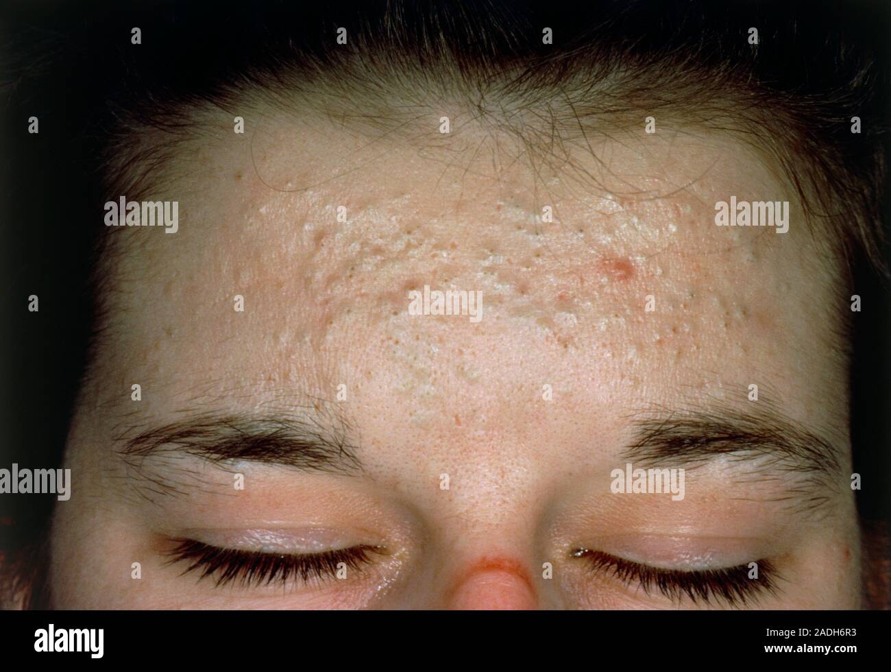 Acne vulgaris affecting a woman's forehead, showing blackhead pustules ...