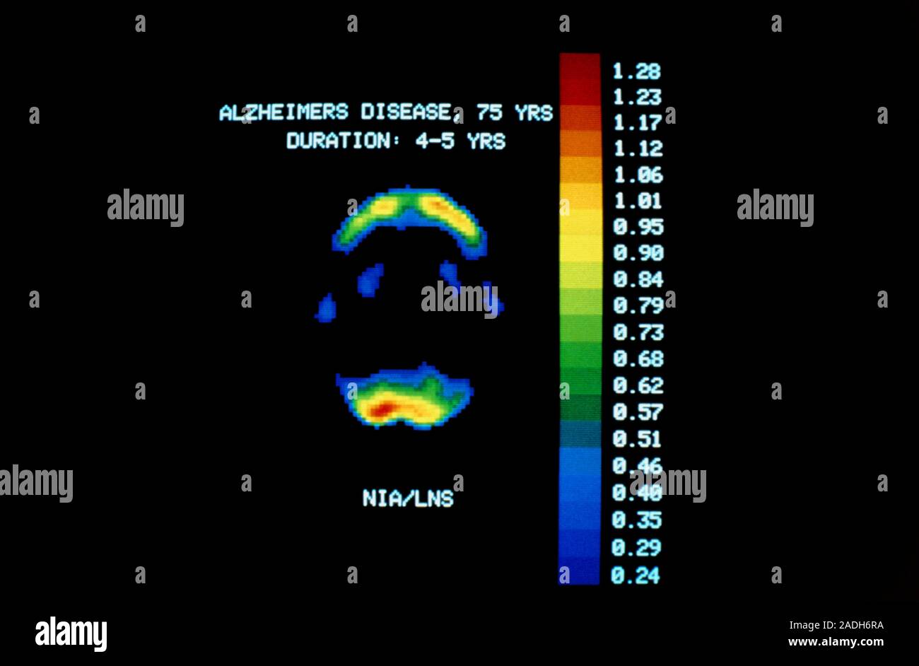 PET scan (positron emission tomography) of the brain of a person ...