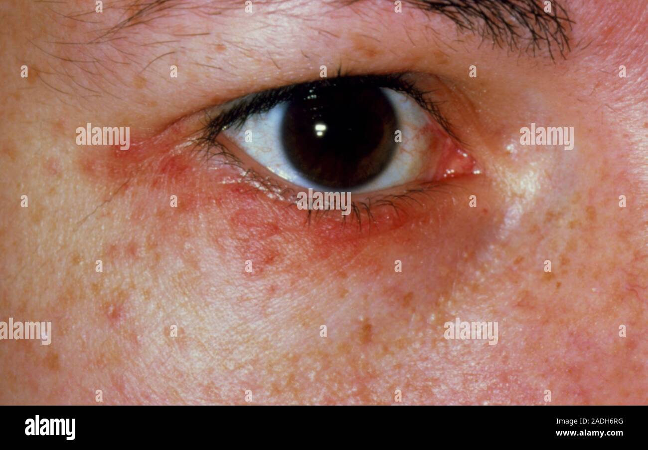 Acne agminata affecting the skin around a young woman's eye. Acne is a ...
