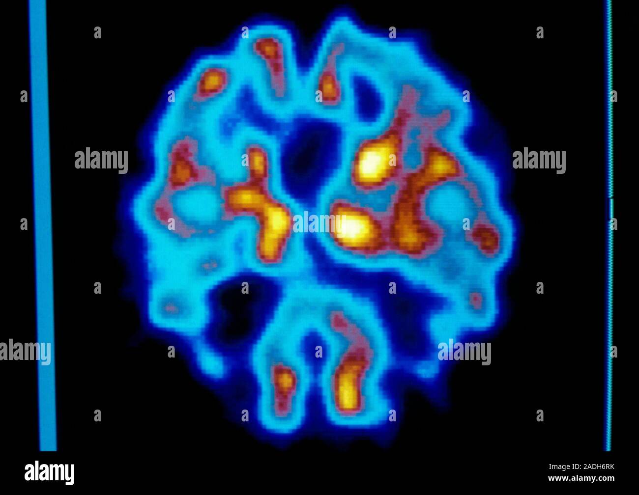 Positron emission tomography (PET) scan of the brain (basal ganglia ...