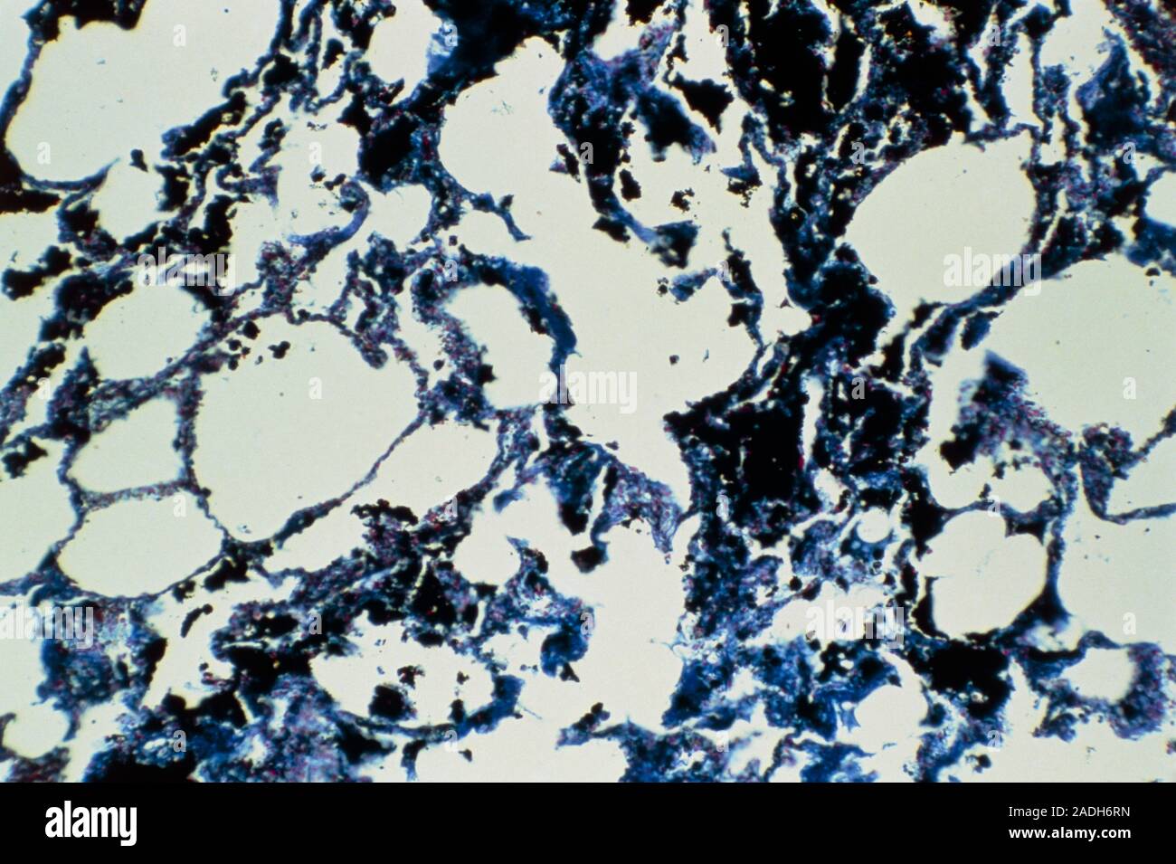 Anthracosis. Light micrograph showing lung tissue affected by coal ...