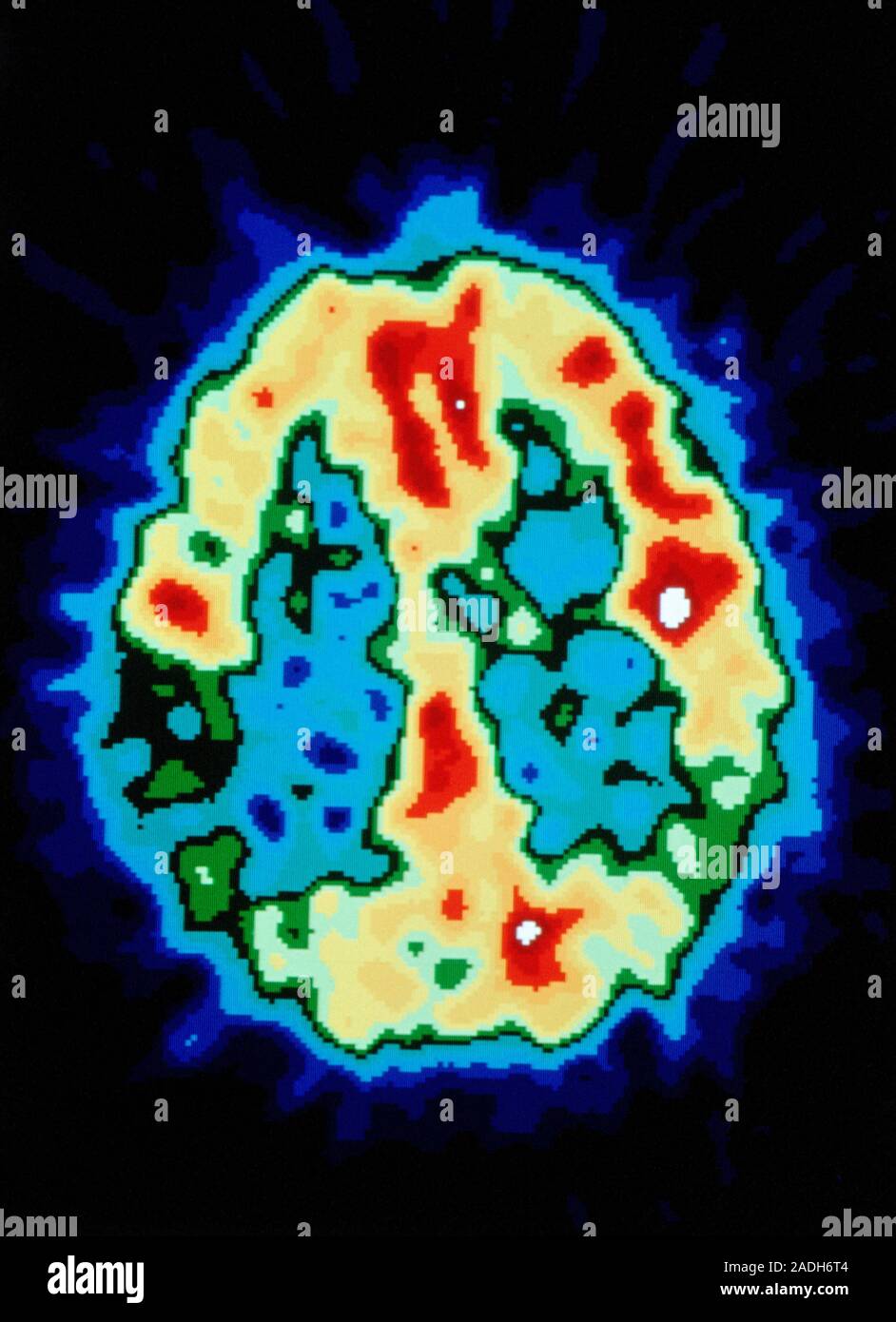 Positron emission tomography (PET) scan of the brain of a patient with ...