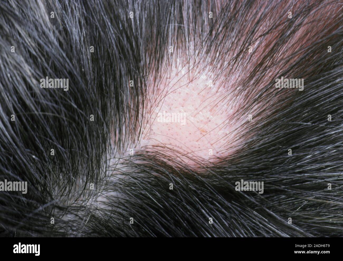 Alopecia areata. View of a patch of hair loss on the scalp of a patient suffering from alopecia ...