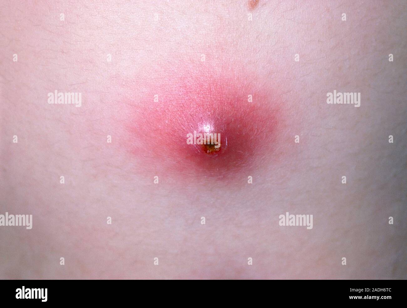 Close-up showing an abscess on the abdomen of a seven year old girl ...