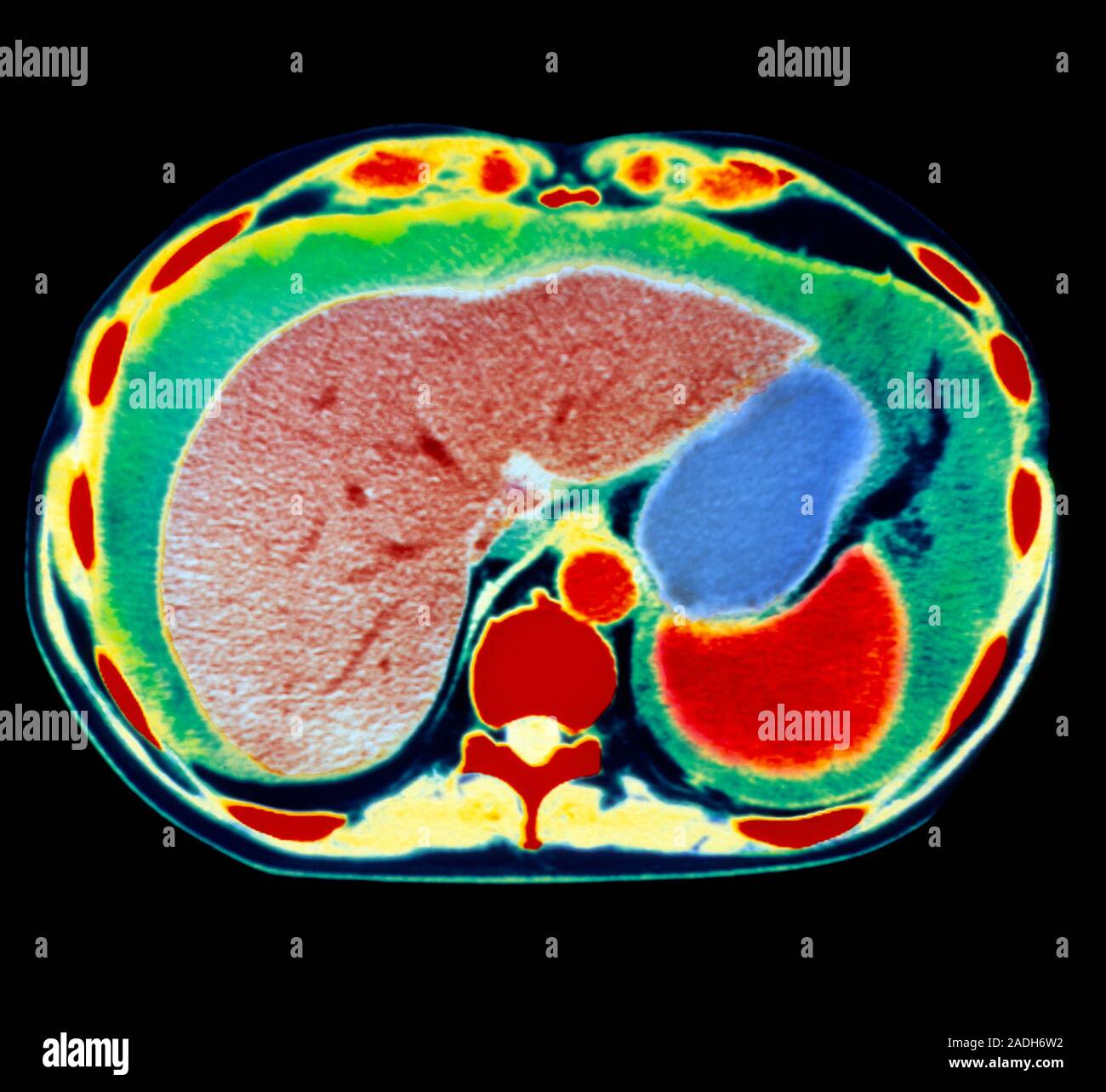 Ascites. Coloured computed Tomography (CT) scan of an axial section ...