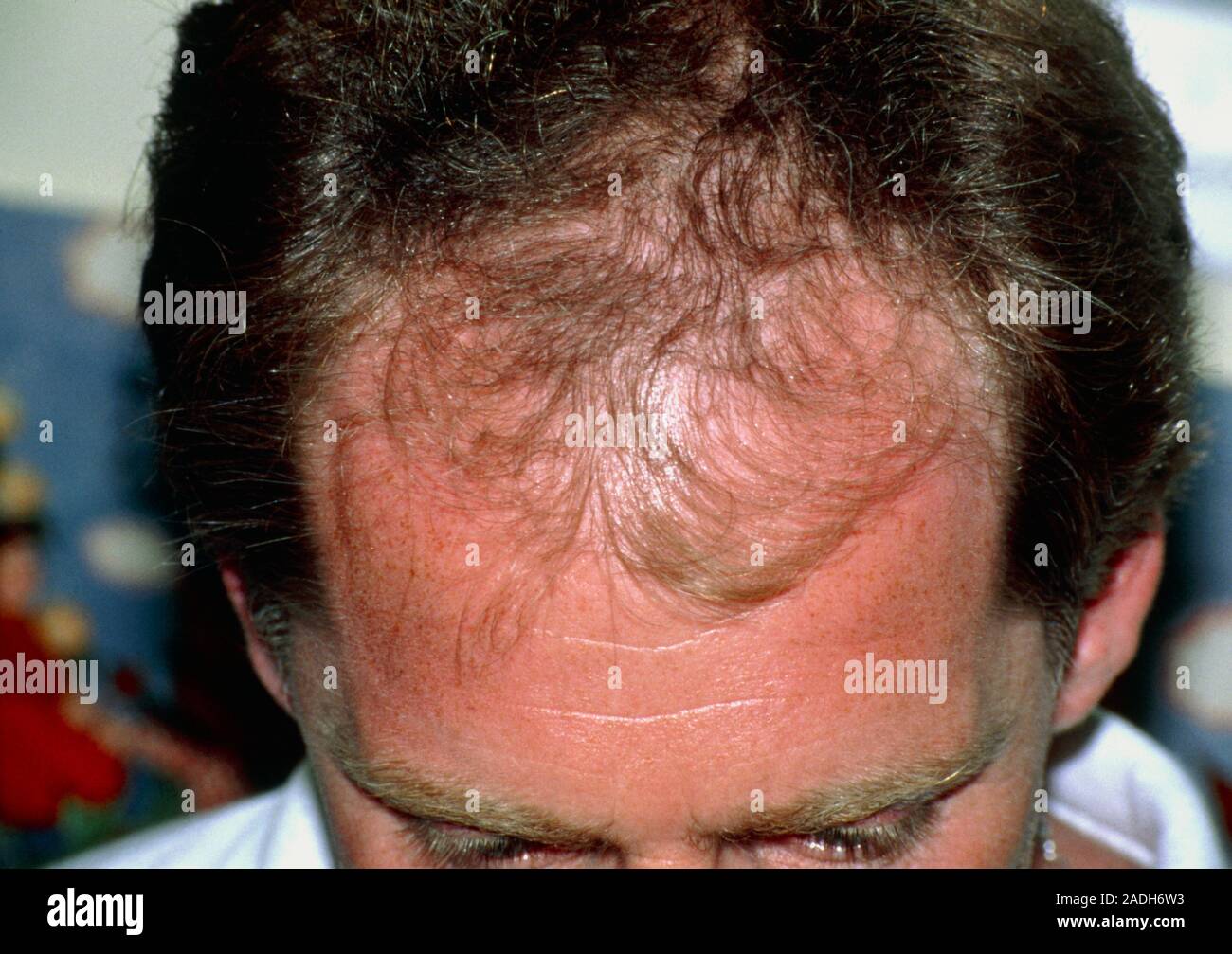 Balding man. Top view of the head of a man with male-pattern baldness ...
