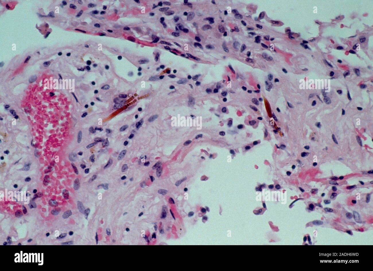 Asbestosis. Light micrograph of asbestos fibres (brown) embedded in ...