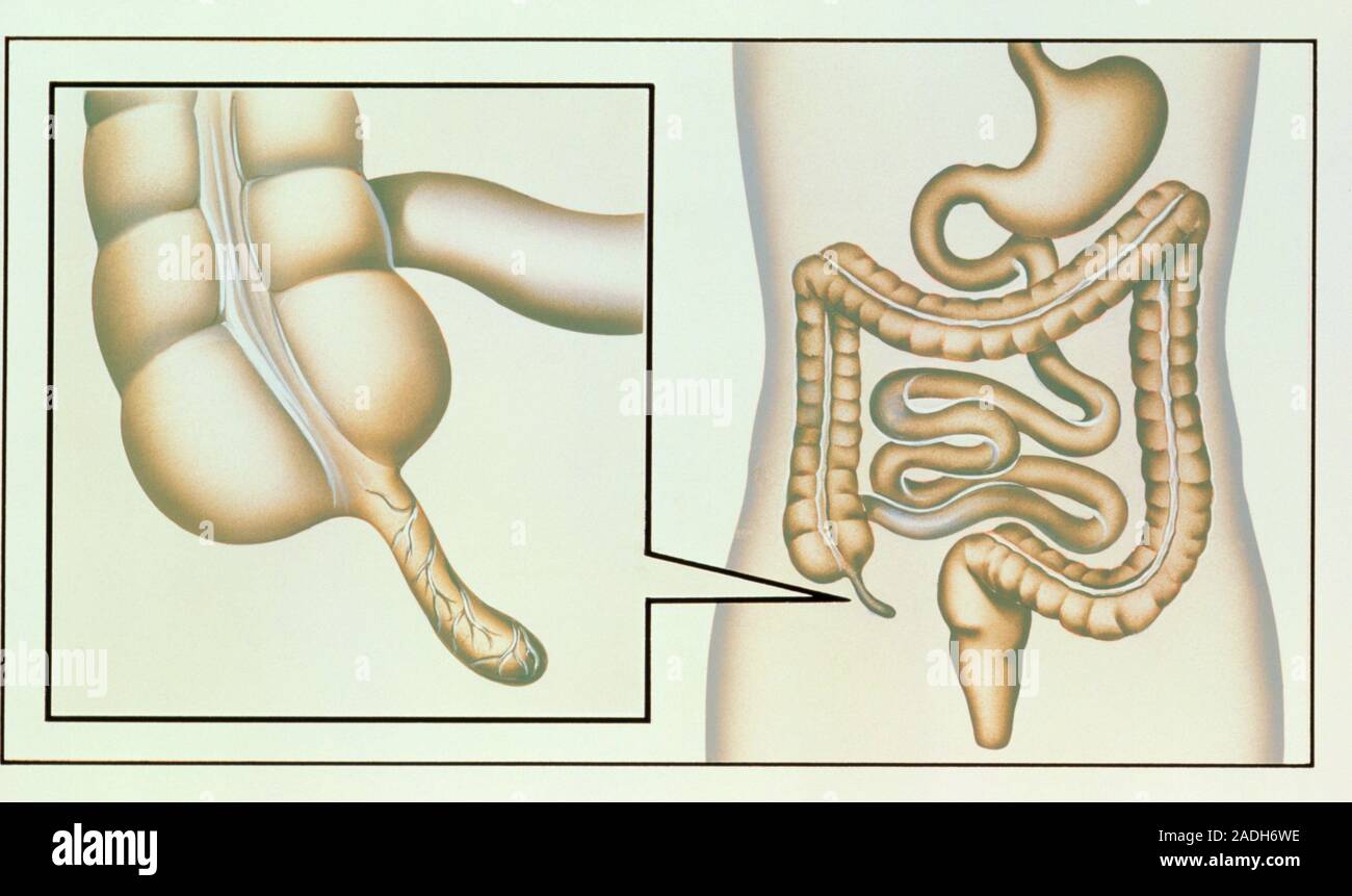 Inflamed appendix. Illustration of the intestines with a close-up ...