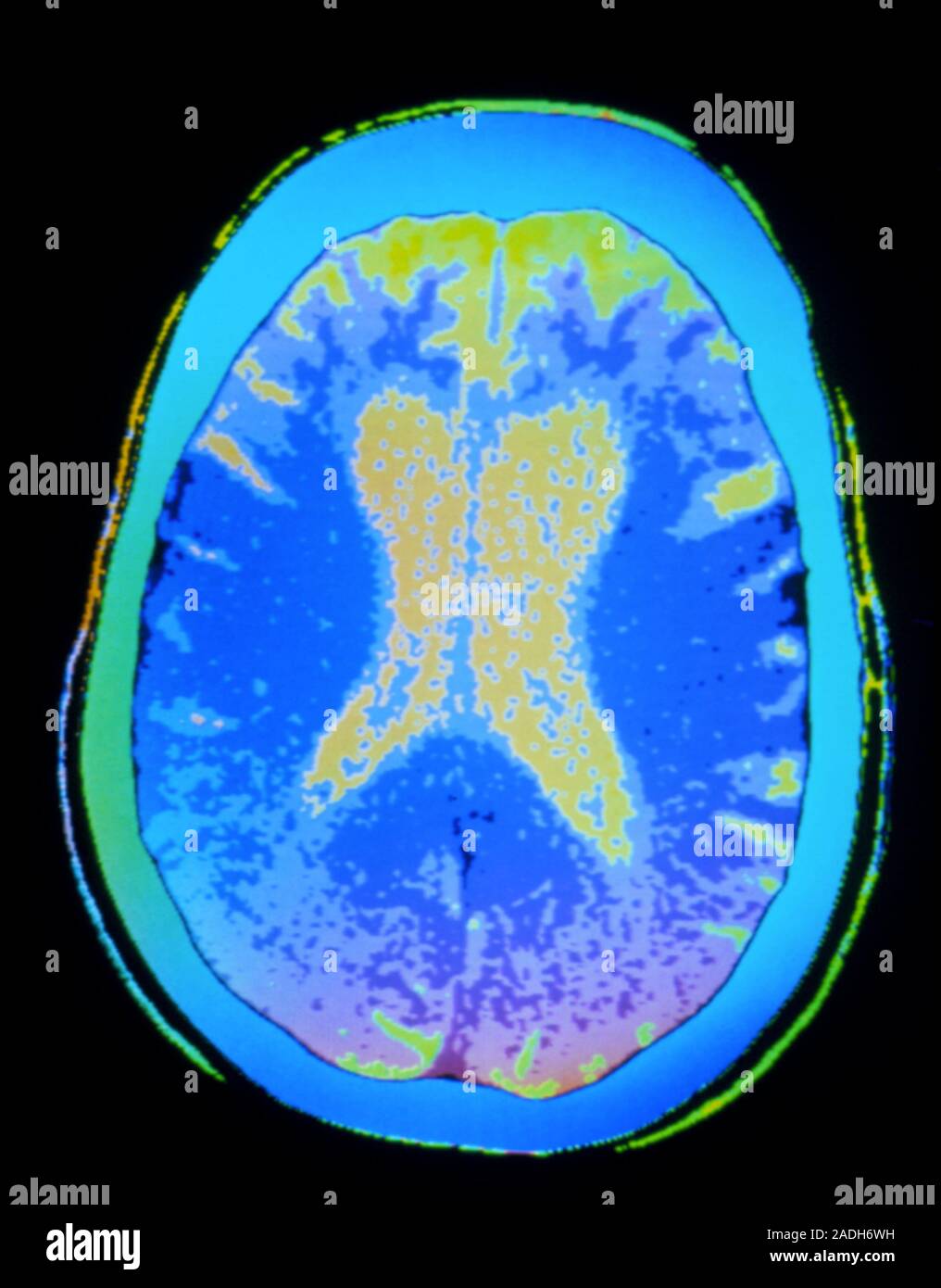 Alzheimer's disease. Coloured computed tomography (CT) scan of an axial ...