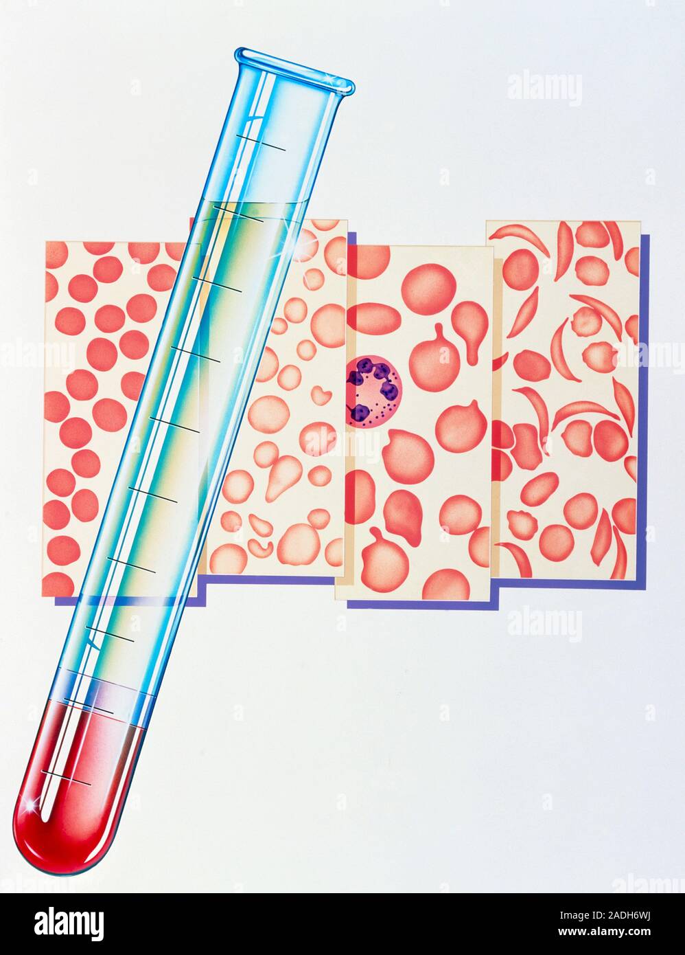 Anaemia. Illustration showing the microscope view of normal red blood ...