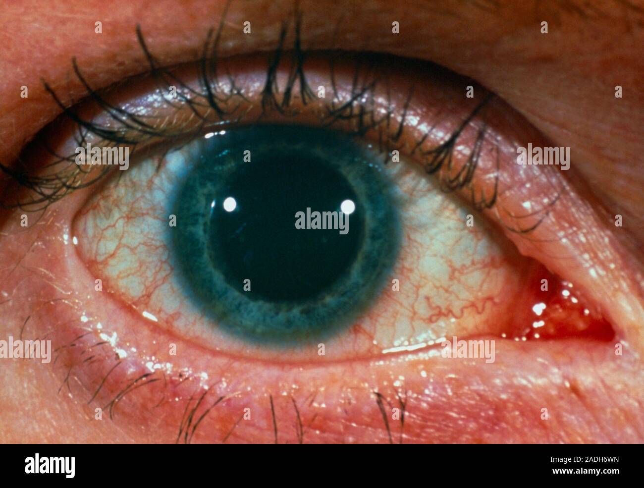Simulated eye test for Alzheimer's disease. Normal eye with pupil ...