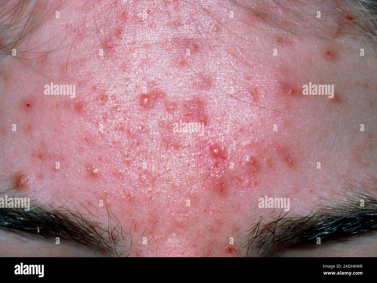 Acne vulgaris on a patient's forehead. Acne is a general term for skin ...