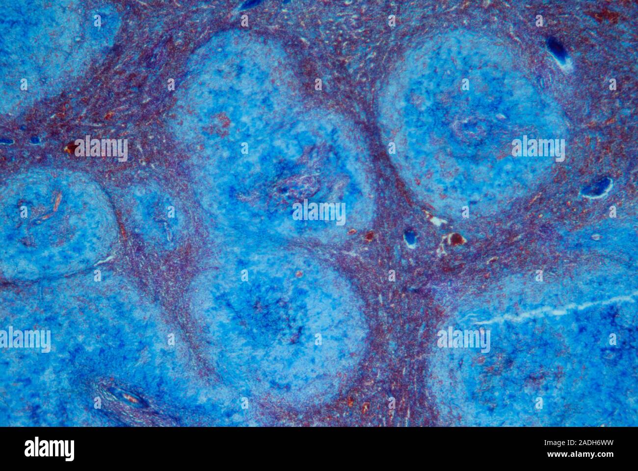 Amyloidosis. Light micrograph of amyloid nodules (blue) in a human ...