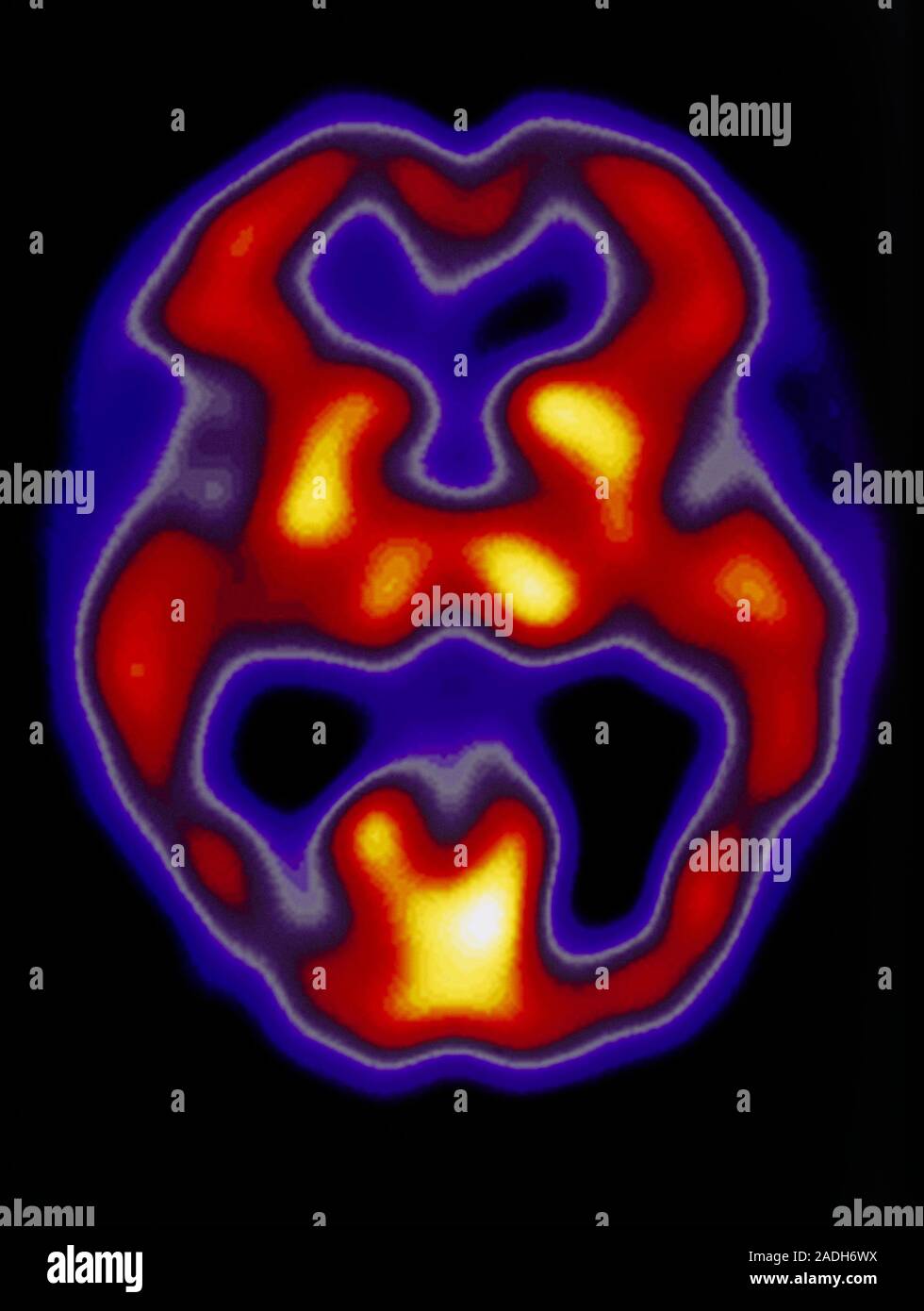 Alzheimer's disease. Colour Single Photon Emission Computed Tomography ...