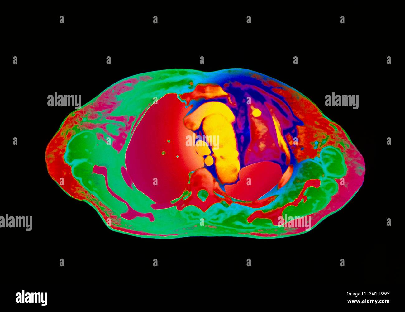 Collapsed lung. Coloured Computed Tomography (CT) scan through a ...