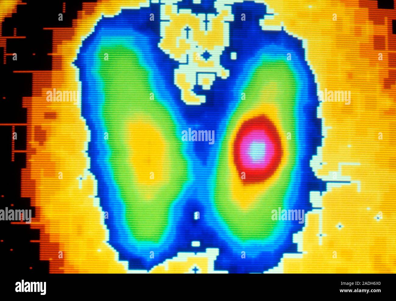 Thyroid adenoma. Coloured gamma scan of a hot nodule" (red and white ...