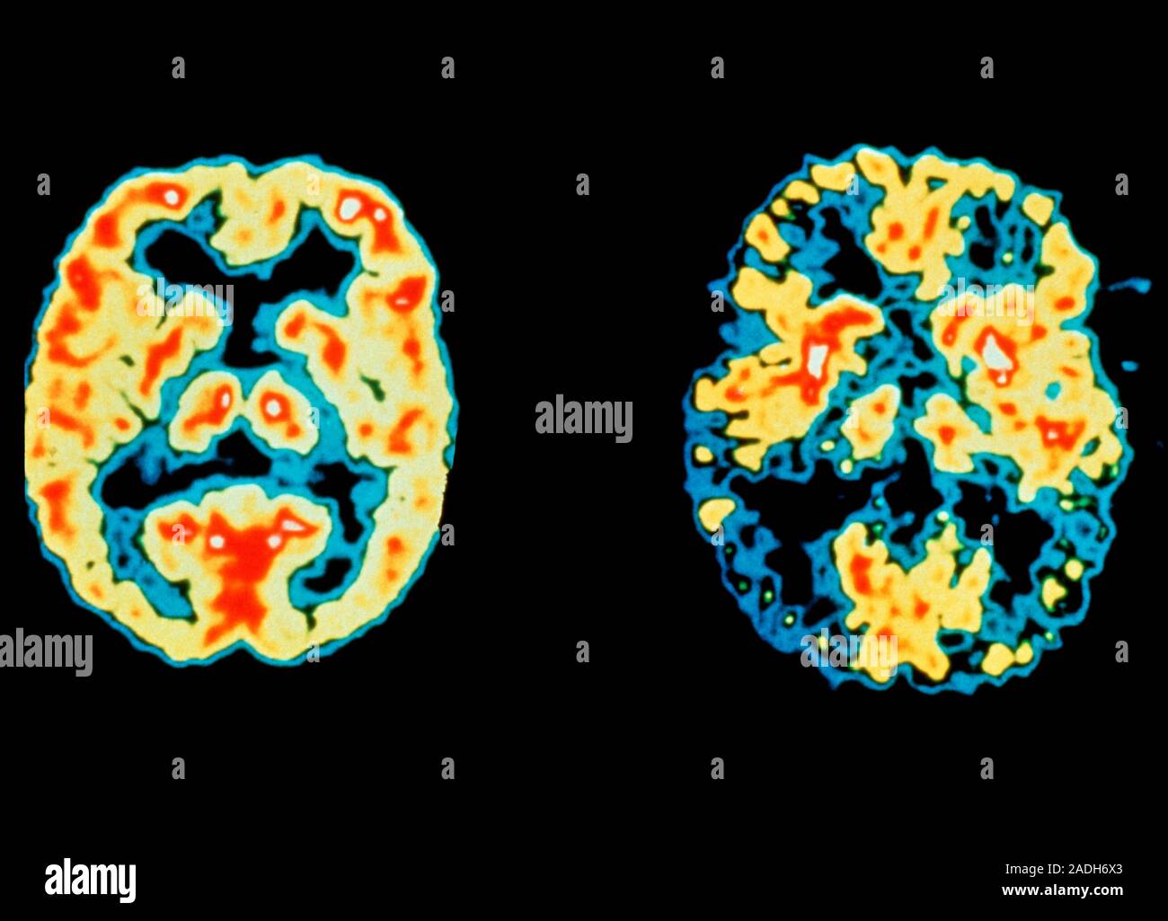 Alzheimer's disease. Coloured Positron Emission Tomography (PET) scans ...