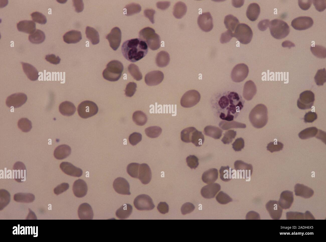 Pernicious anaemia. Light micrograph of a blood smear in a patient ...