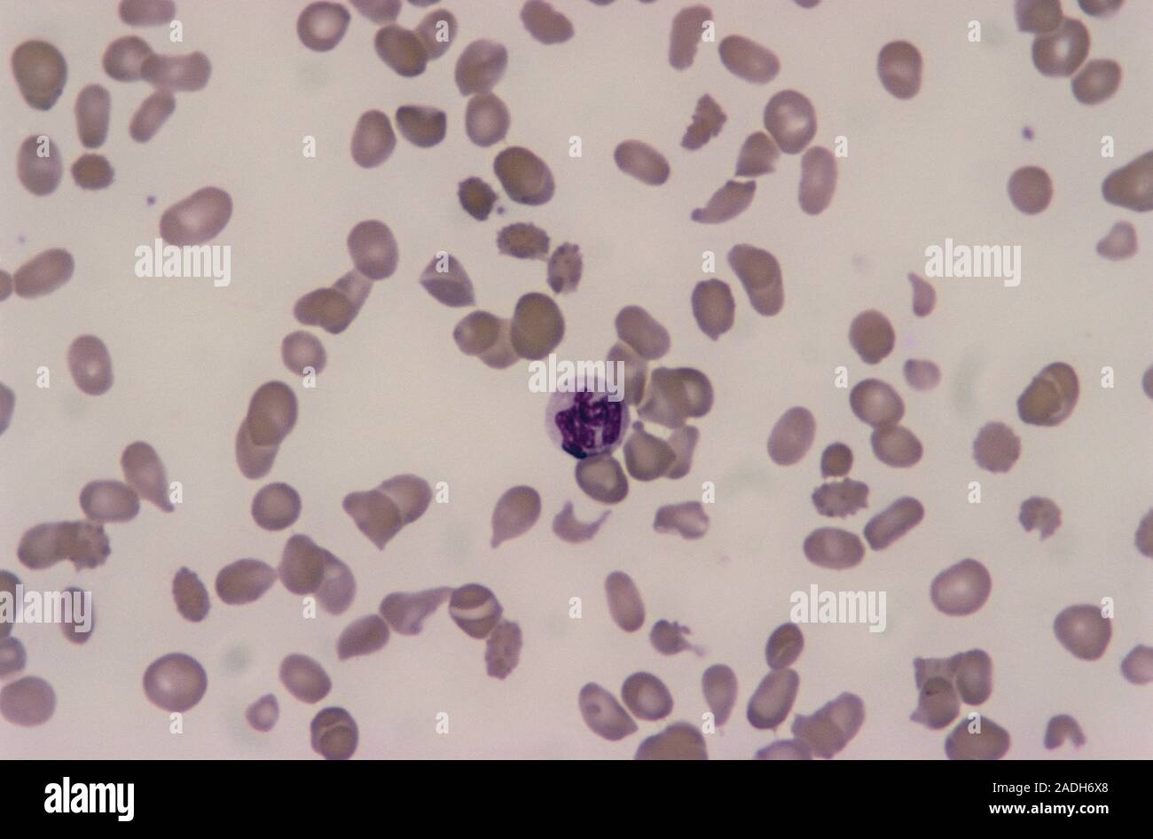 Pernicious anaemia. Light micrograph of a blood smear in a patient ...
