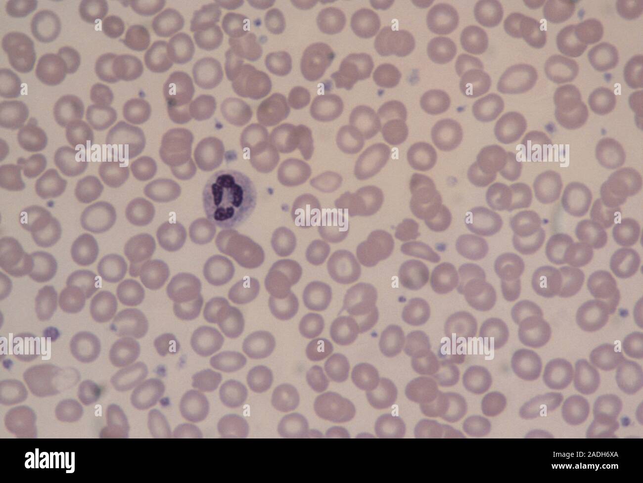 Iron deficiency anaemia. Light micrograph of a blood smear in a patient ...