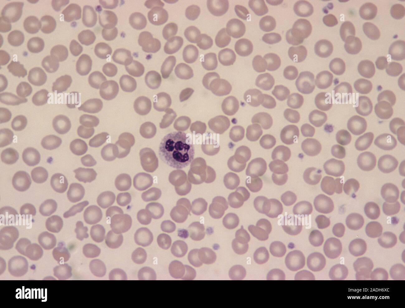 Iron-deficiency anaemia. Light micrograph of a blood smear in a patient ...