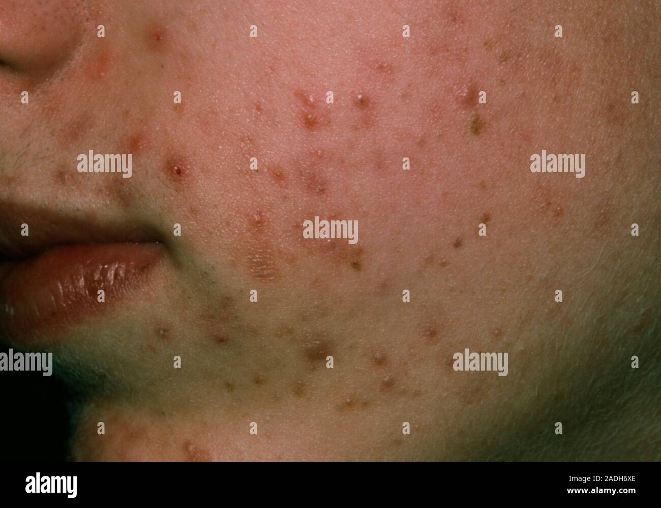 Acne vulgaris. Acne vulgaris seen on the cheek of a teenager. Acne is a ...